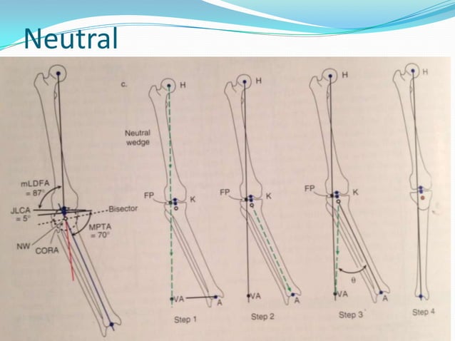 High Tibial Osteotomy_UTSAV | PPTX