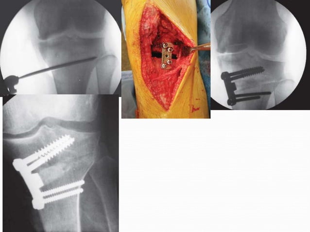 High Tibial Osteotomy_UTSAV | PPTX