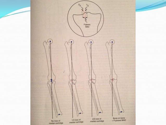 High Tibial Osteotomy_UTSAV | PPTX