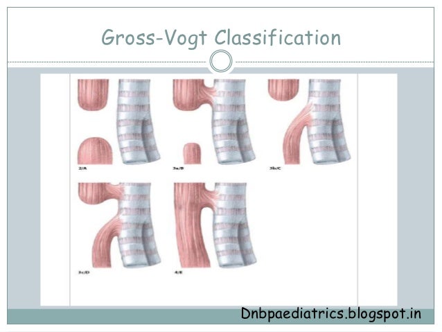 Tracheoesophageal Fistula Classification