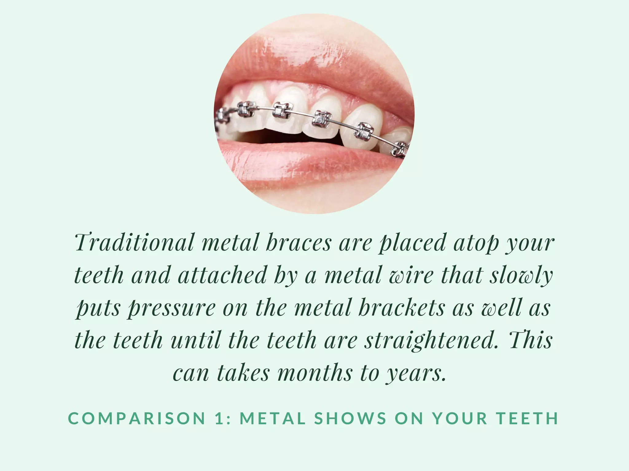 Invisalign Clear Aligners Vs. Traditional Metal Braces | PDF