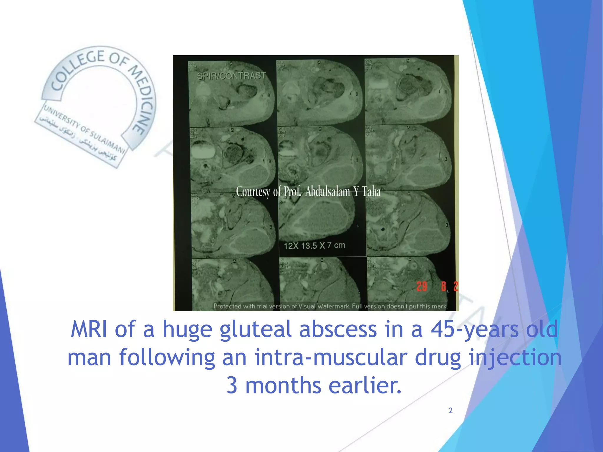 Huge Gluteal Abscess following Intra-muscular Drug Injection.pdf