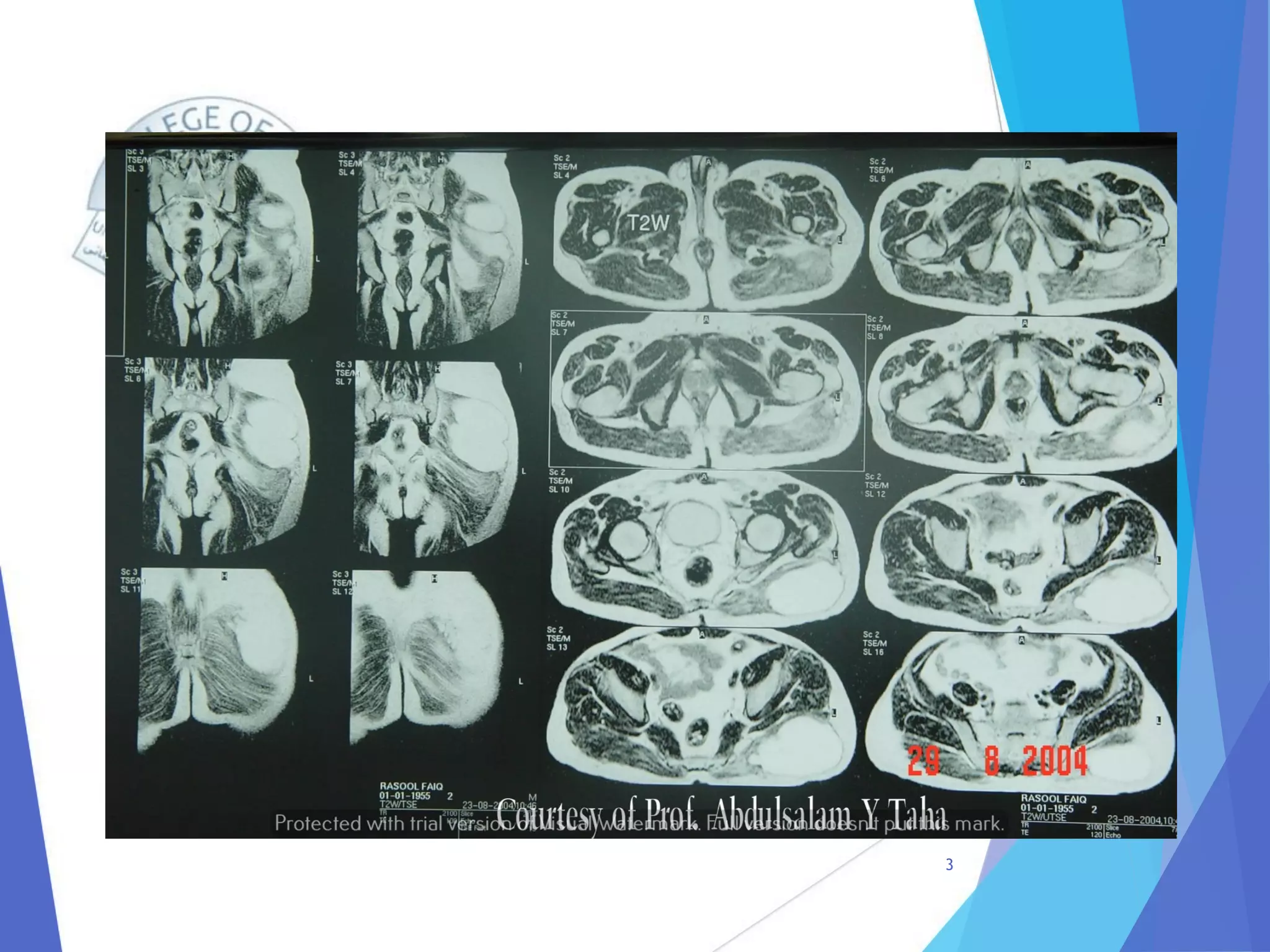 Huge Gluteal Abscess following Intra-muscular Drug Injection.pdf