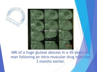 Huge Gluteal Abscess following Intra-muscular Drug Injection.pdf