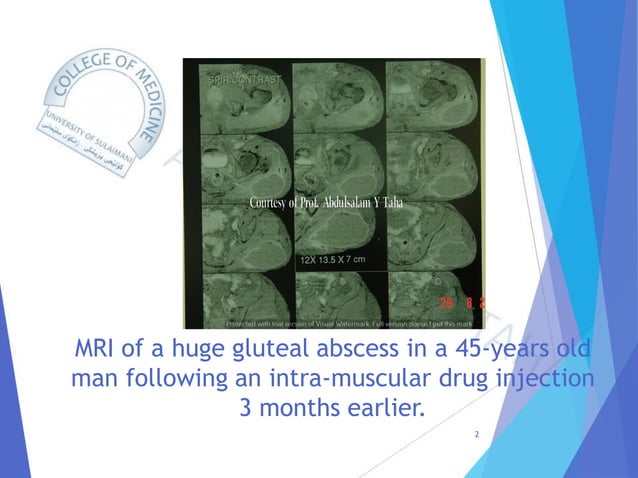 Huge Gluteal Abscess following Intra-muscular Drug Injection.pdf
