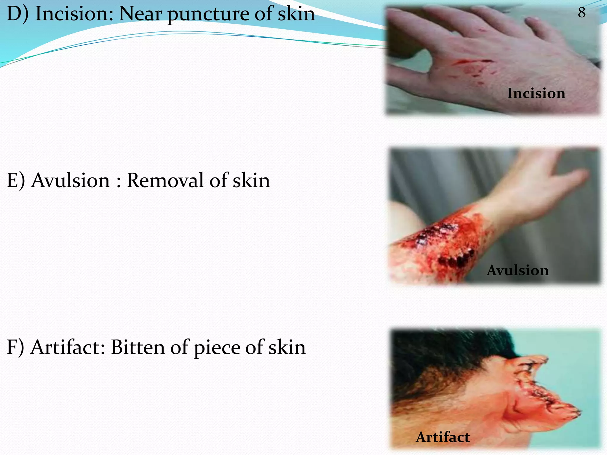 Human bite marks | PPTX