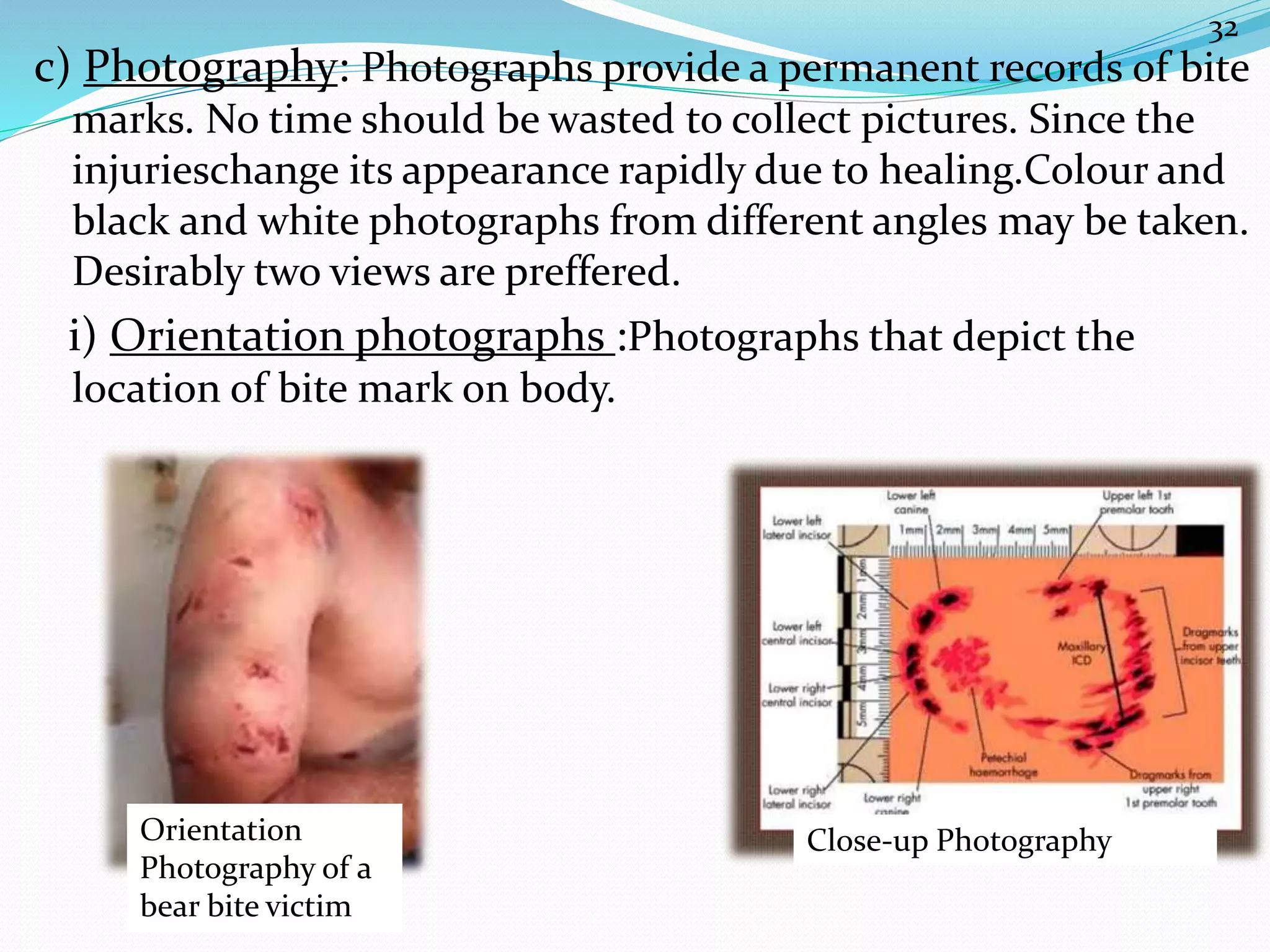 Human bite marks | PPTX