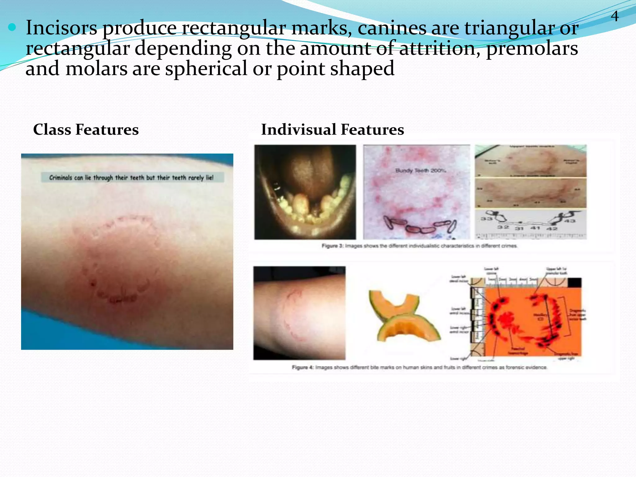Human bite marks | PPTX