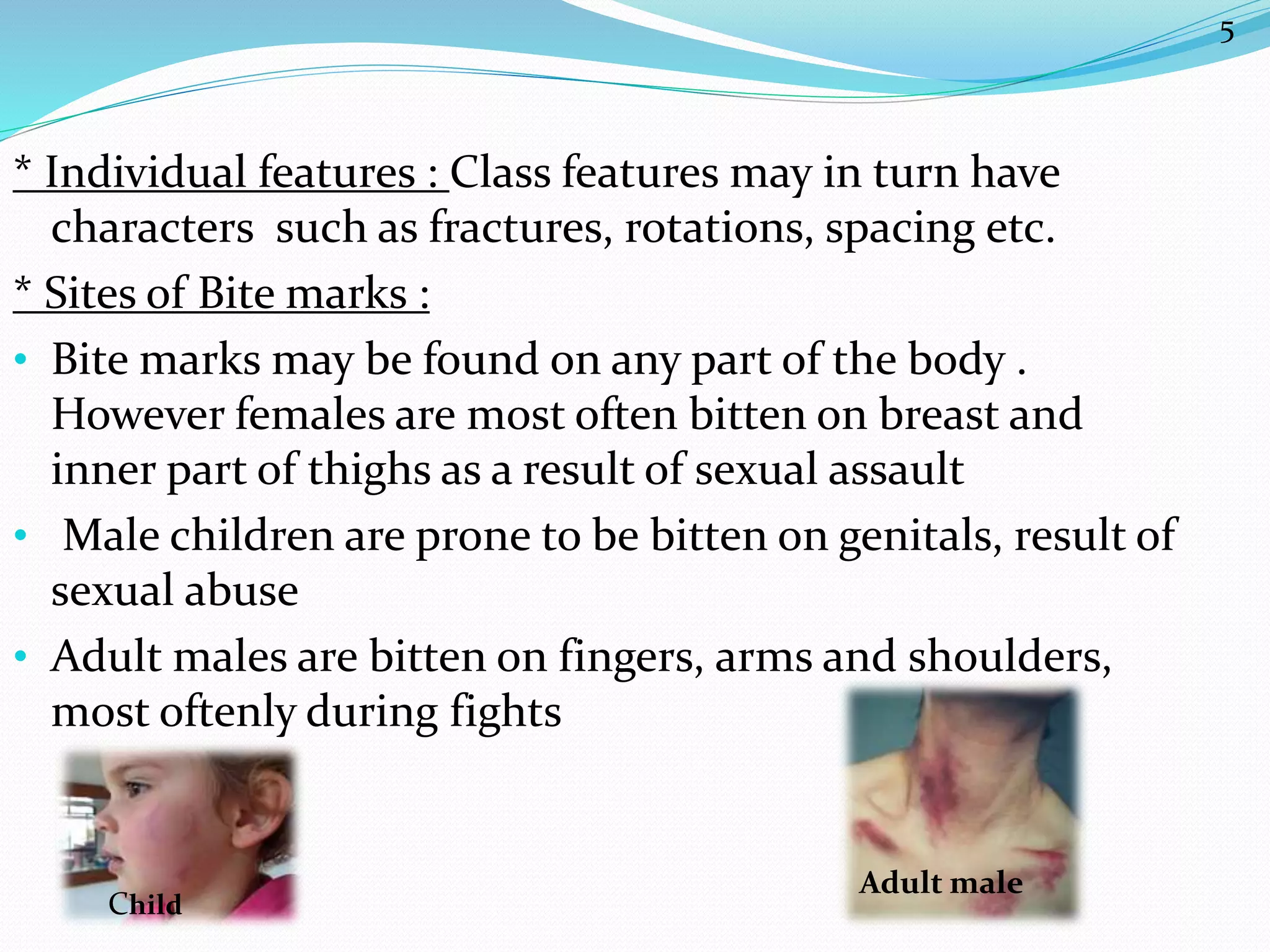 Human bite marks | PPTX
