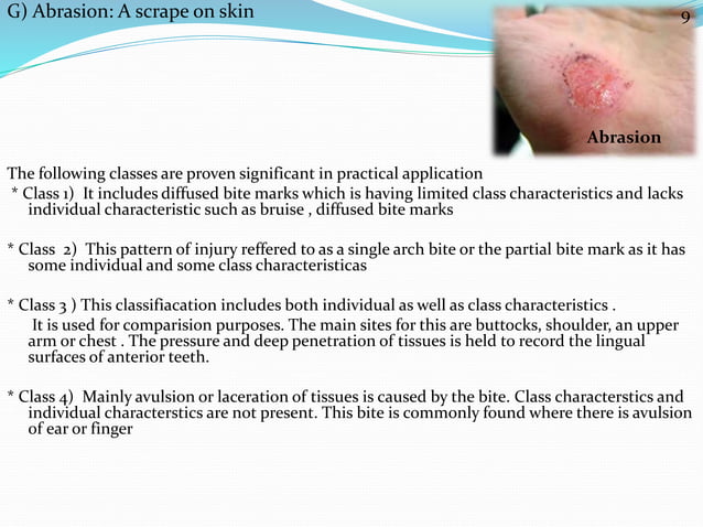 Human bite marks | PPTX | Oral care | Personal Care