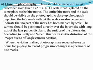 Human bite marks | PPTX