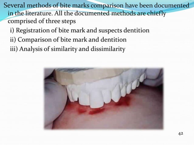 Human bite marks | PPTX | Oral care | Personal Care