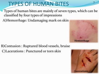 Human Bite Marks On Skin