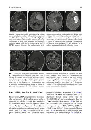 Human brain and spinal cord tumors neurology.pdf
