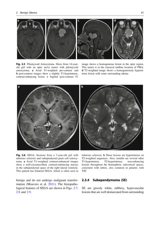 Human brain and spinal cord tumors neurology.pdf
