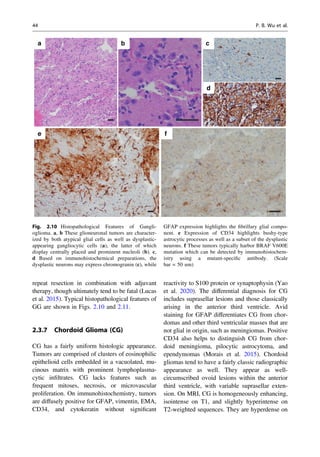 Human brain and spinal cord tumors neurology.pdf