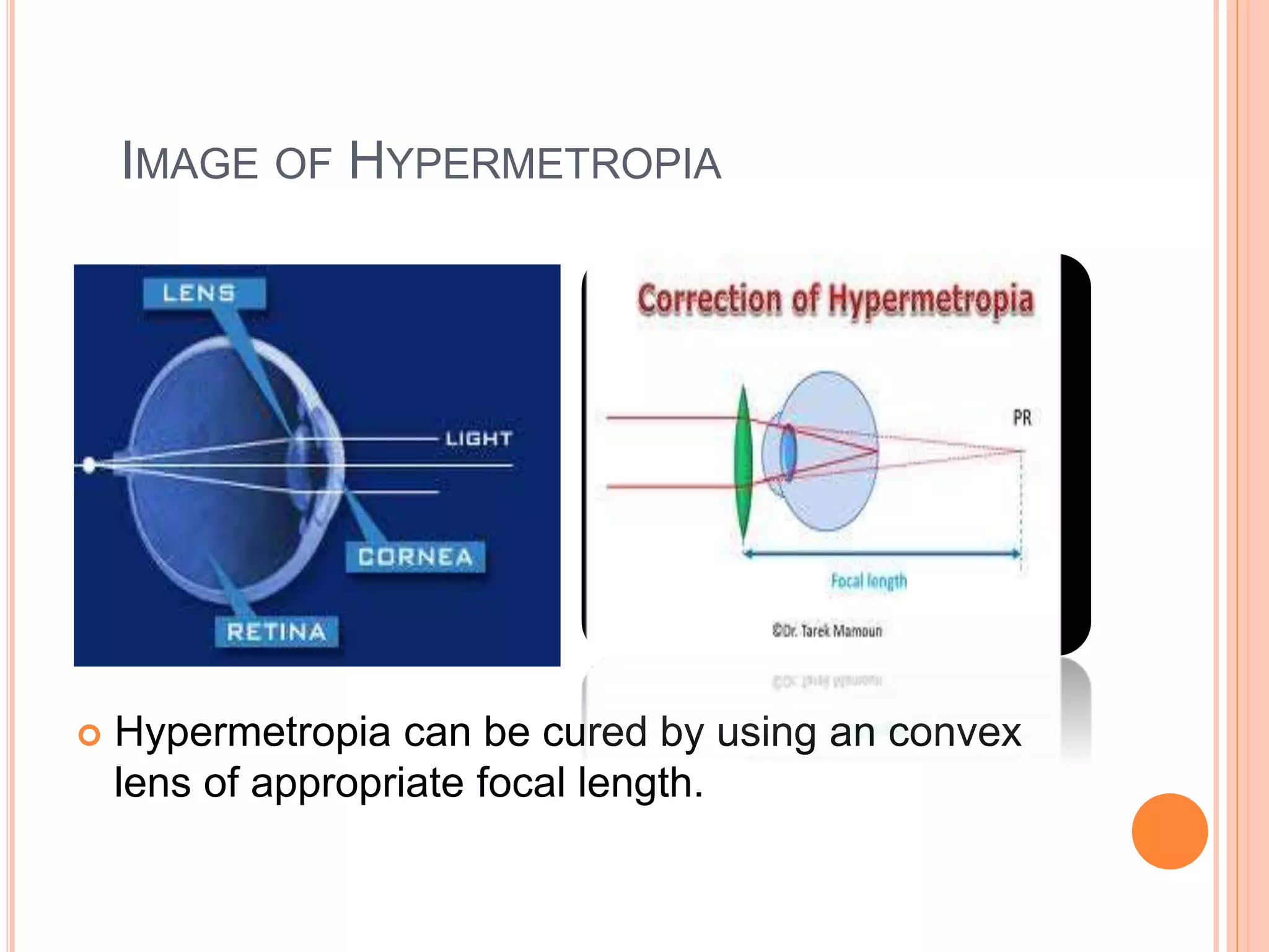 Human eye care and defects | PPTX