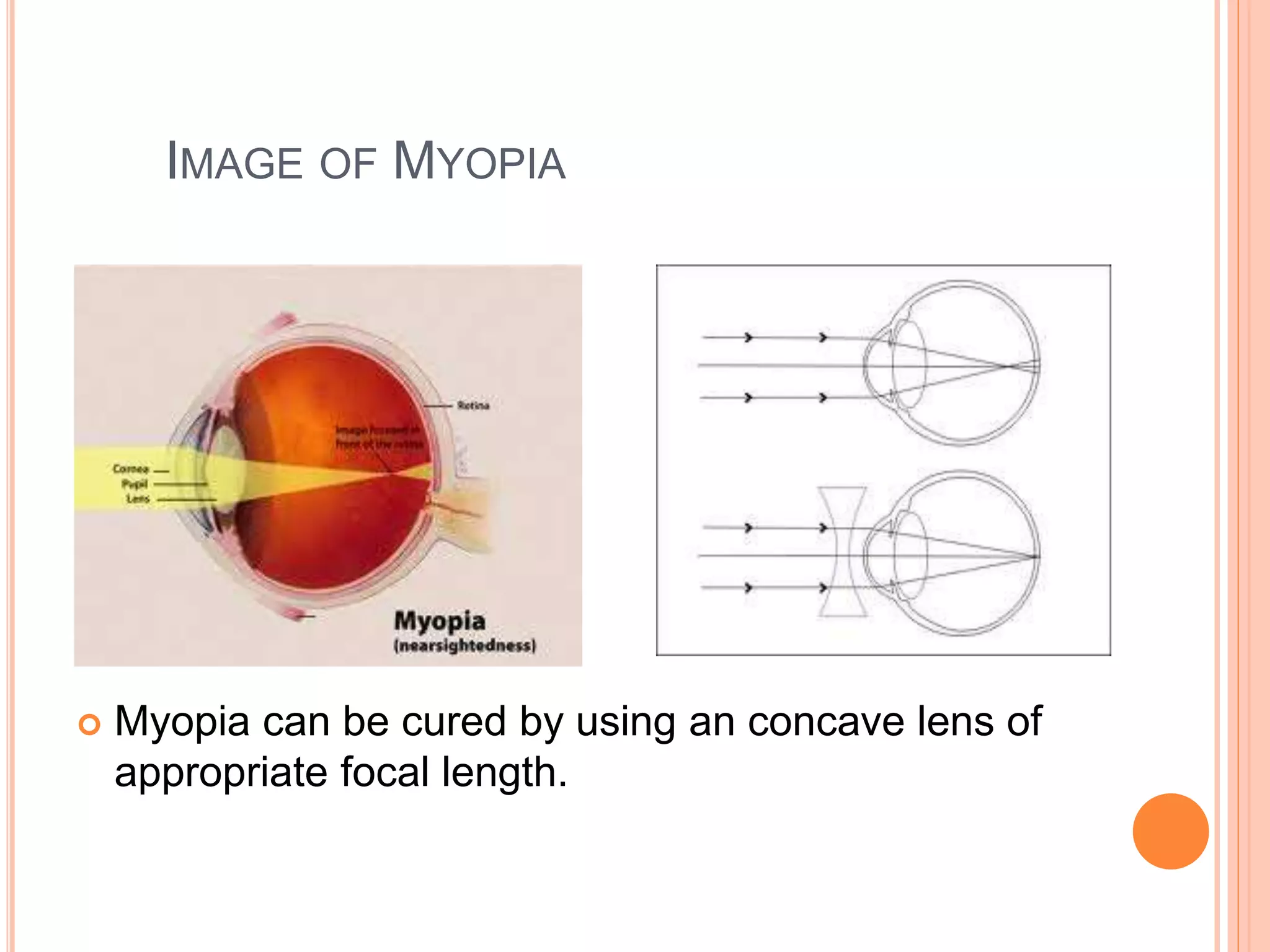 Human eye care and defects | PPTX