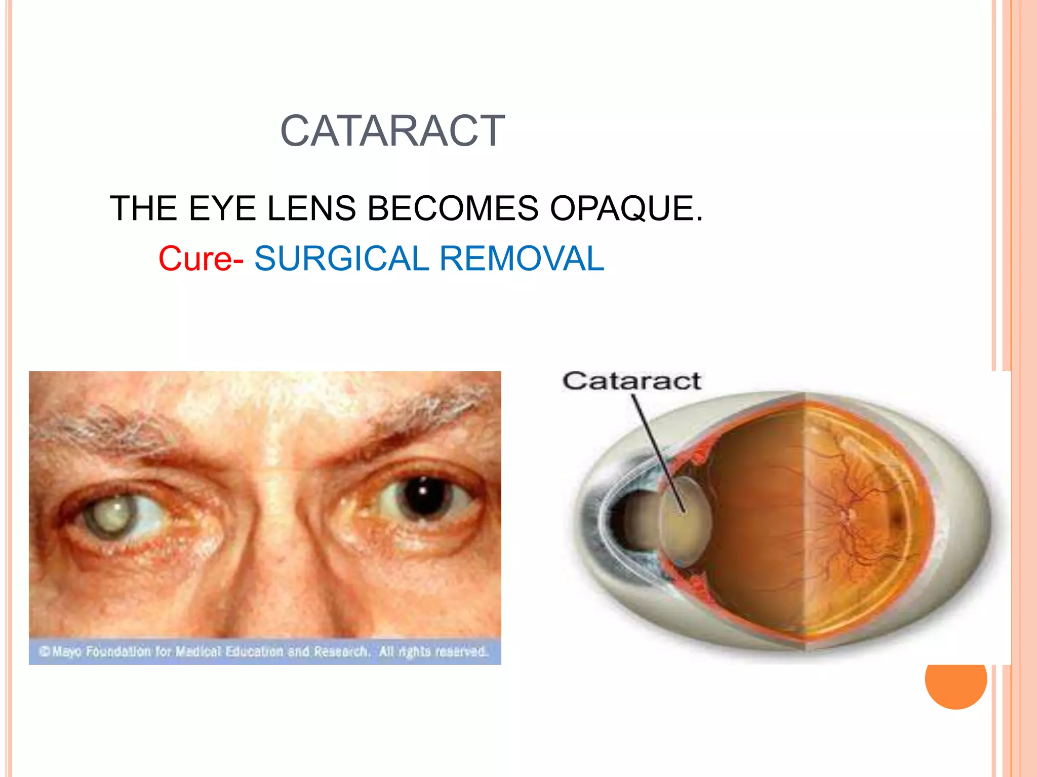 Human eye care and defects | PPTX