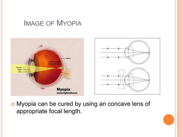 Human eye care and defects | PPTX | Eye and Vision Conditions ...