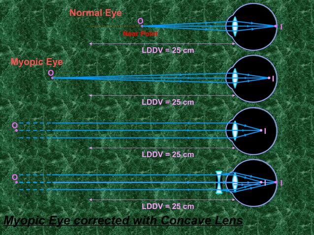 Human eye class 10 | PPT | Eye and Vision Conditions | Diseases and ...