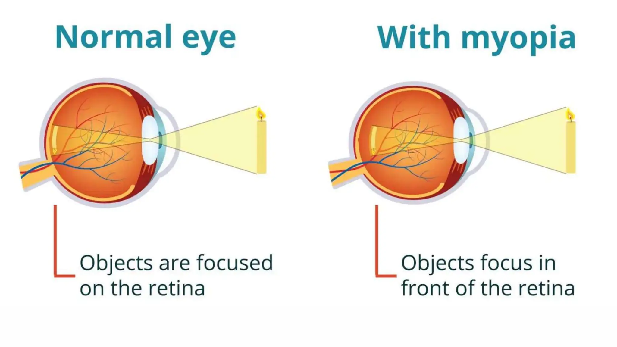 Human eye and colourful world class 10 .pptx | Eye and Vision ...