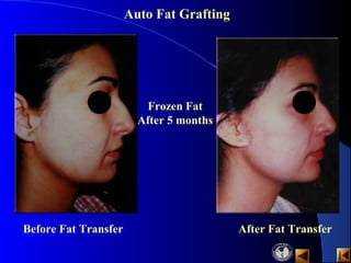 Human fat tissue bank | PPS