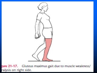 Gluteus Maximus Gait