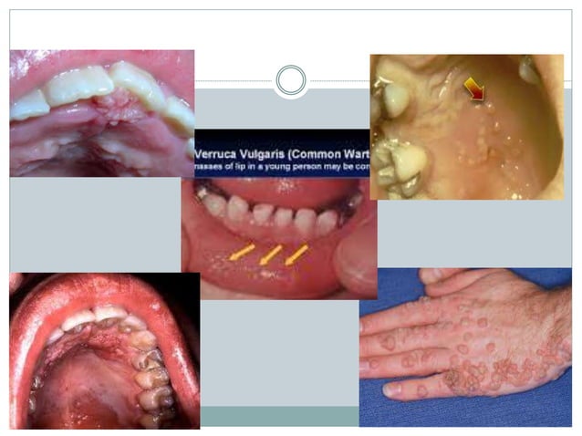 Human papillomavirus in the oral cavity of children | PPTX | Dental ...