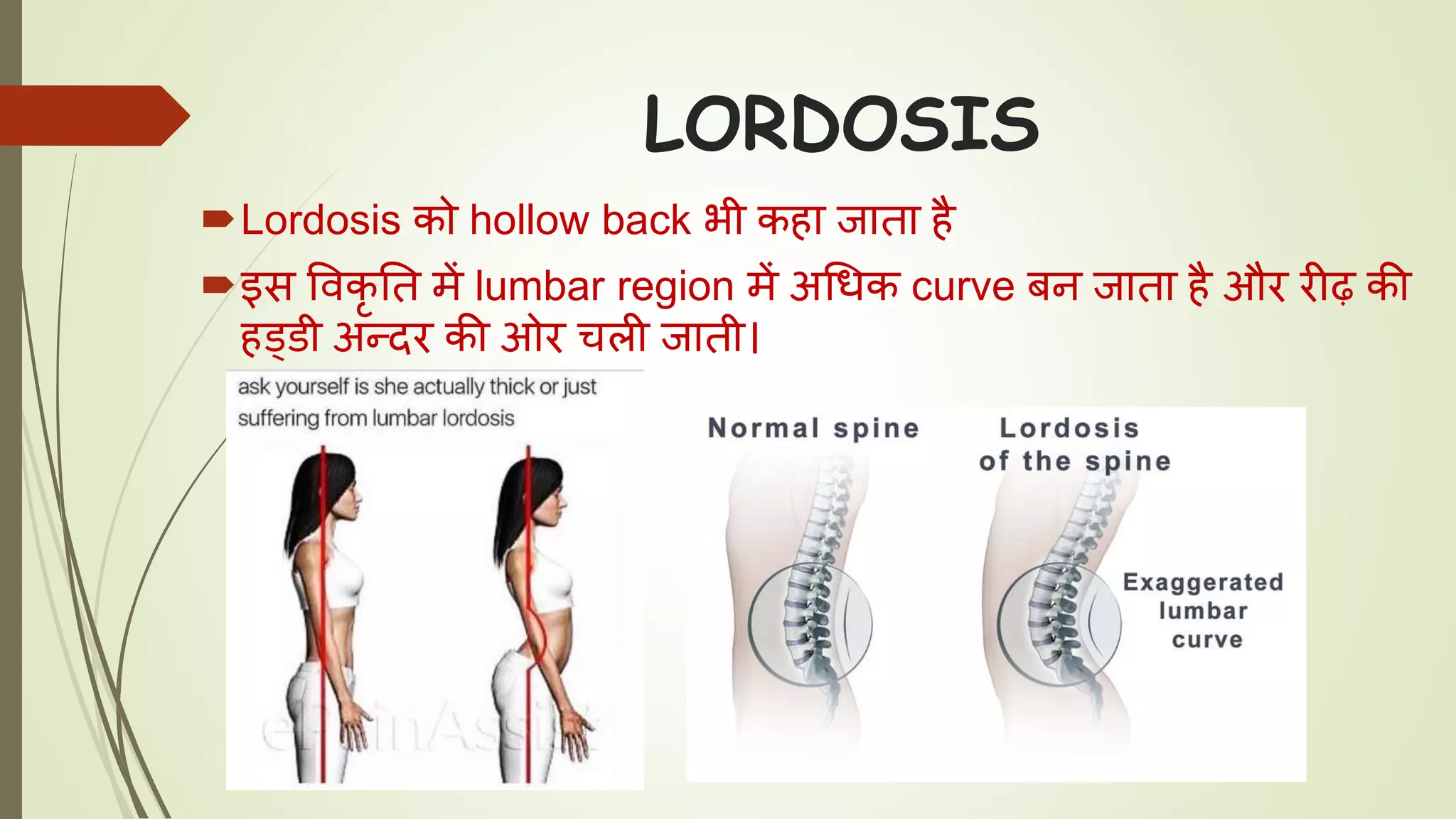 Human Postural Deformities Corrected by Yoga. | PPT