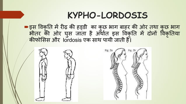 Human Postural Deformities Corrected by Yoga. | PPT