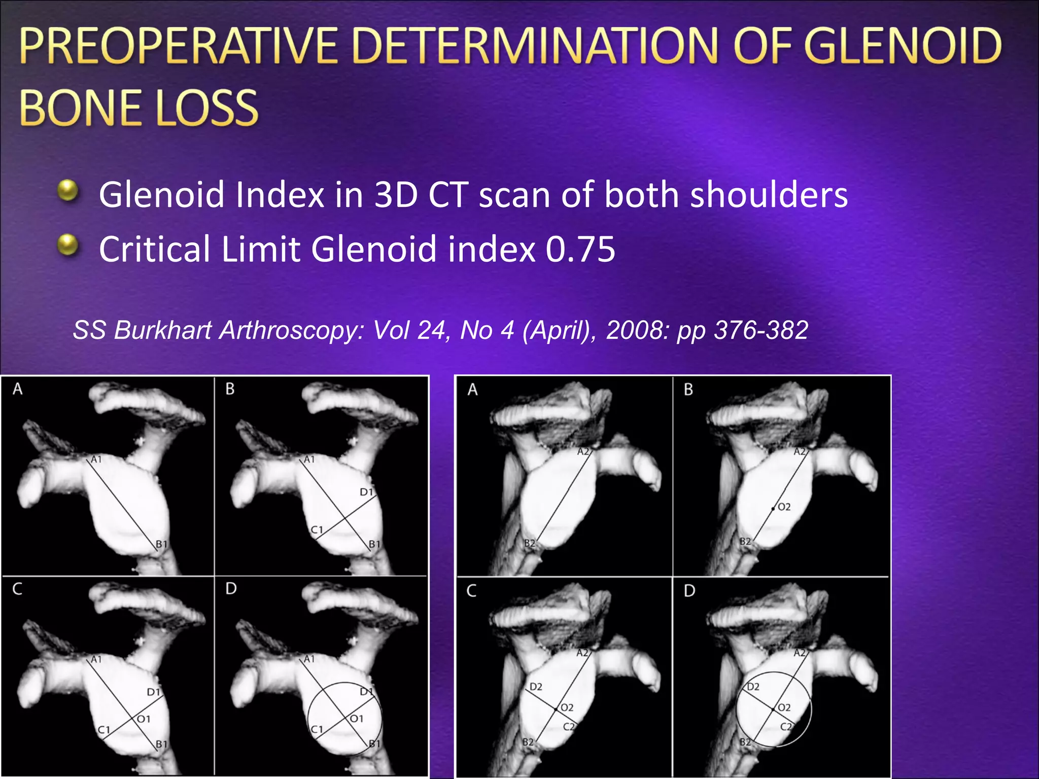 Humeral and glenoid bone defects as factors | PPT
