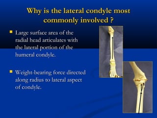 Humeral fractures 1 5 15 aseh | PPT