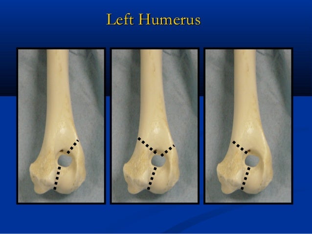 Humerusfractuur