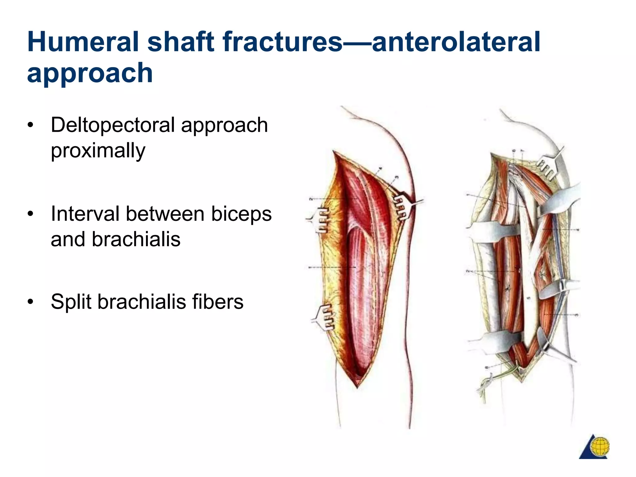 humerus shaft | PPTX