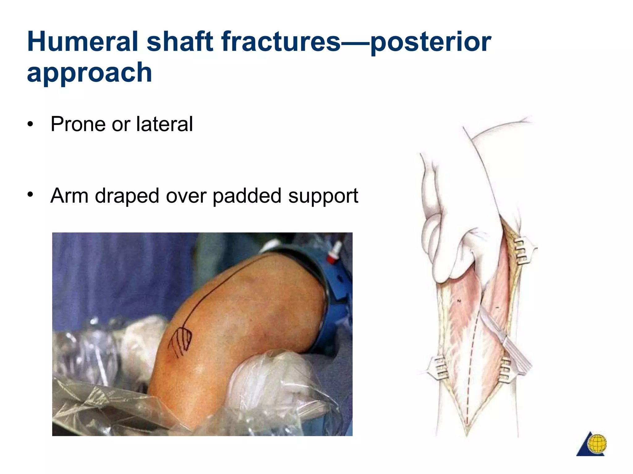 humerus shaft | PPTX