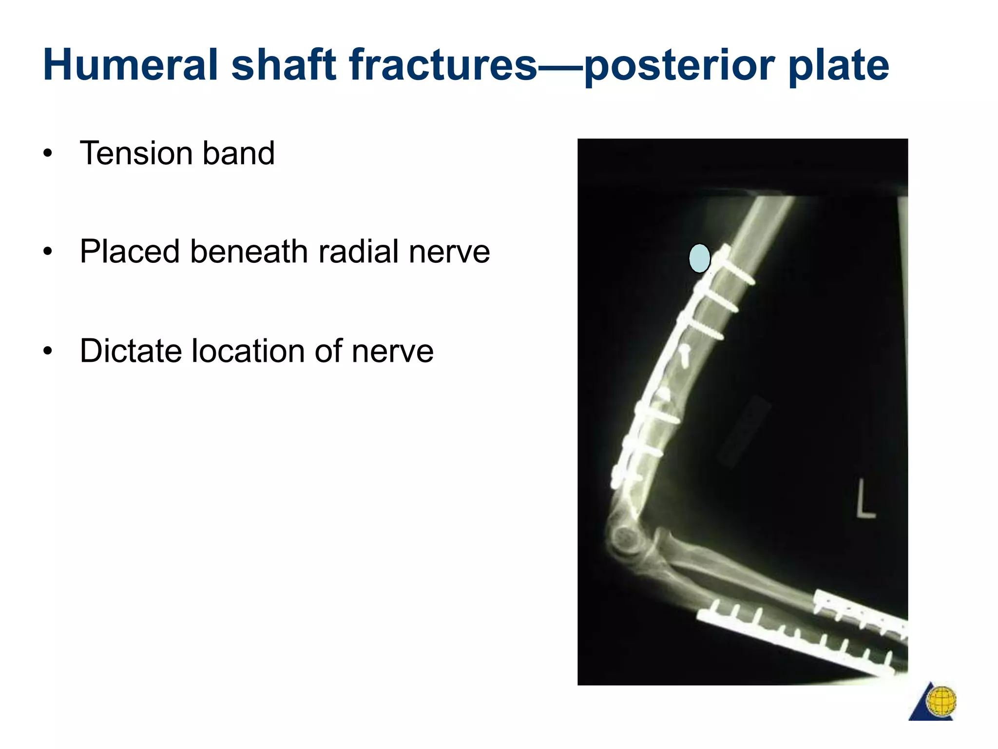 humerus shaft | PPTX