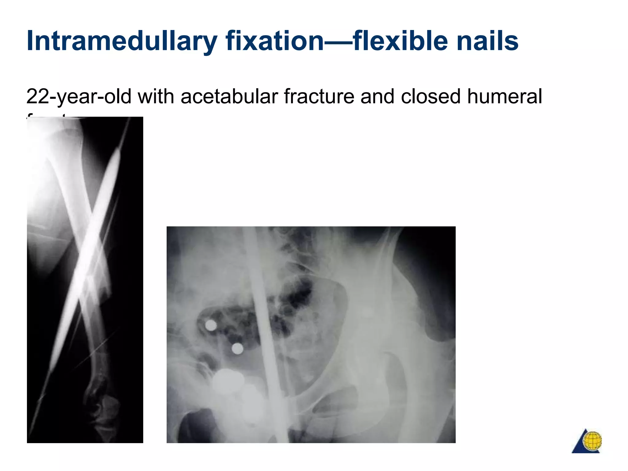 humerus shaft | PPTX