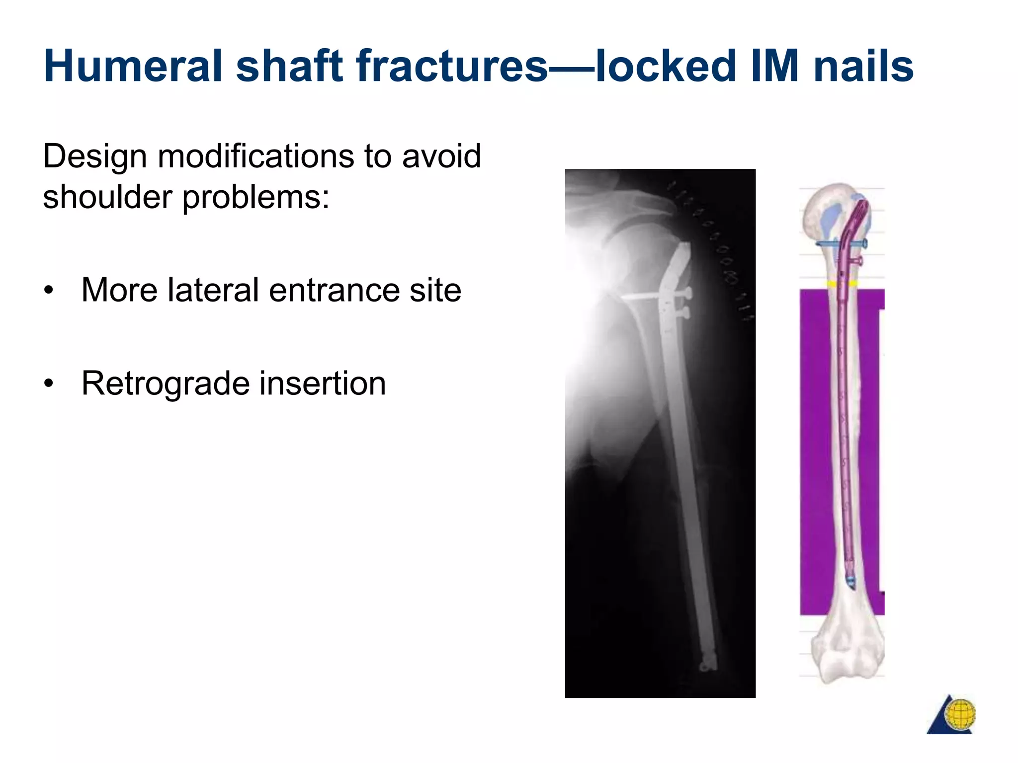 humerus shaft | PPTX