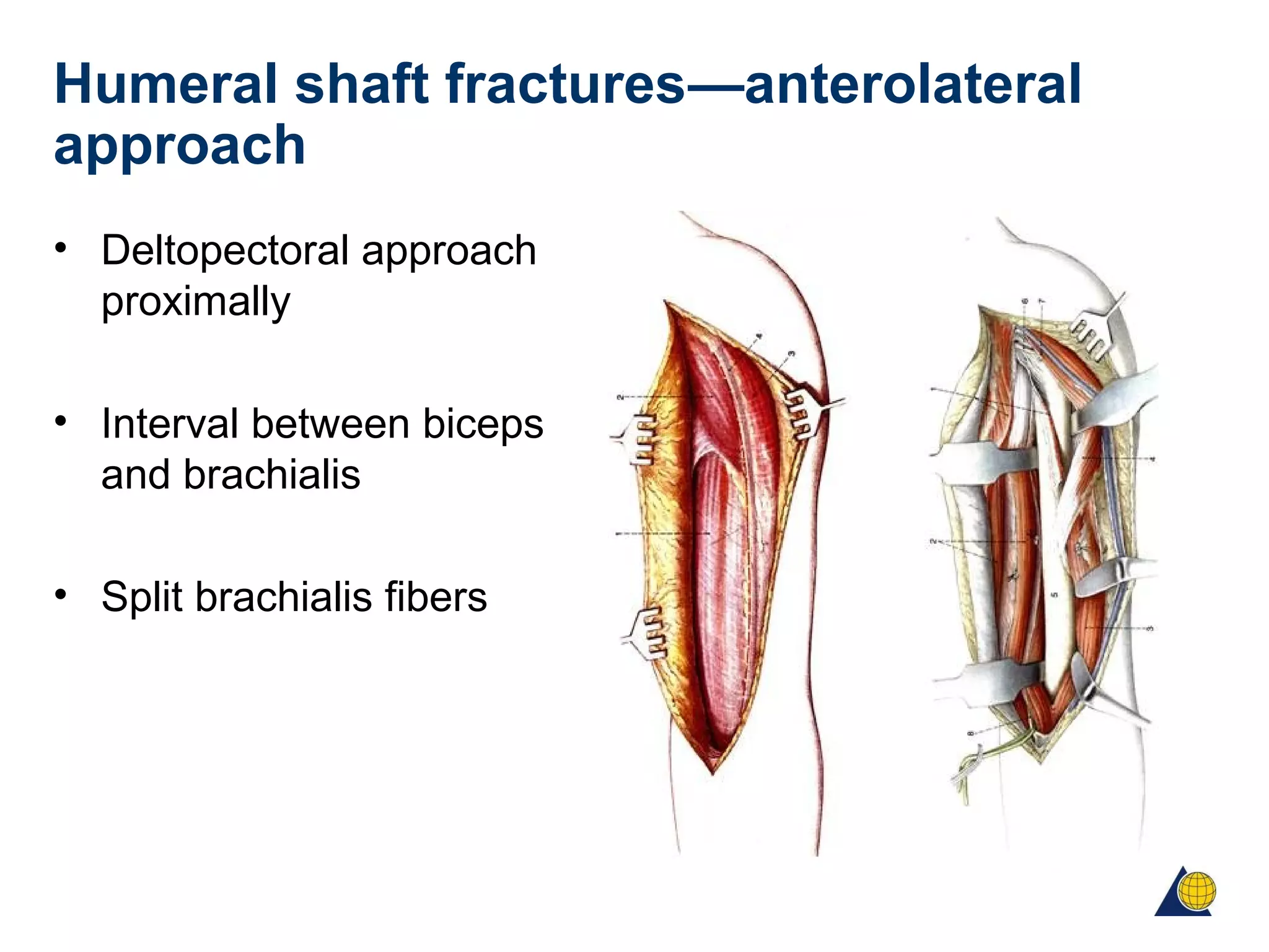 Humeral shaft | PPT