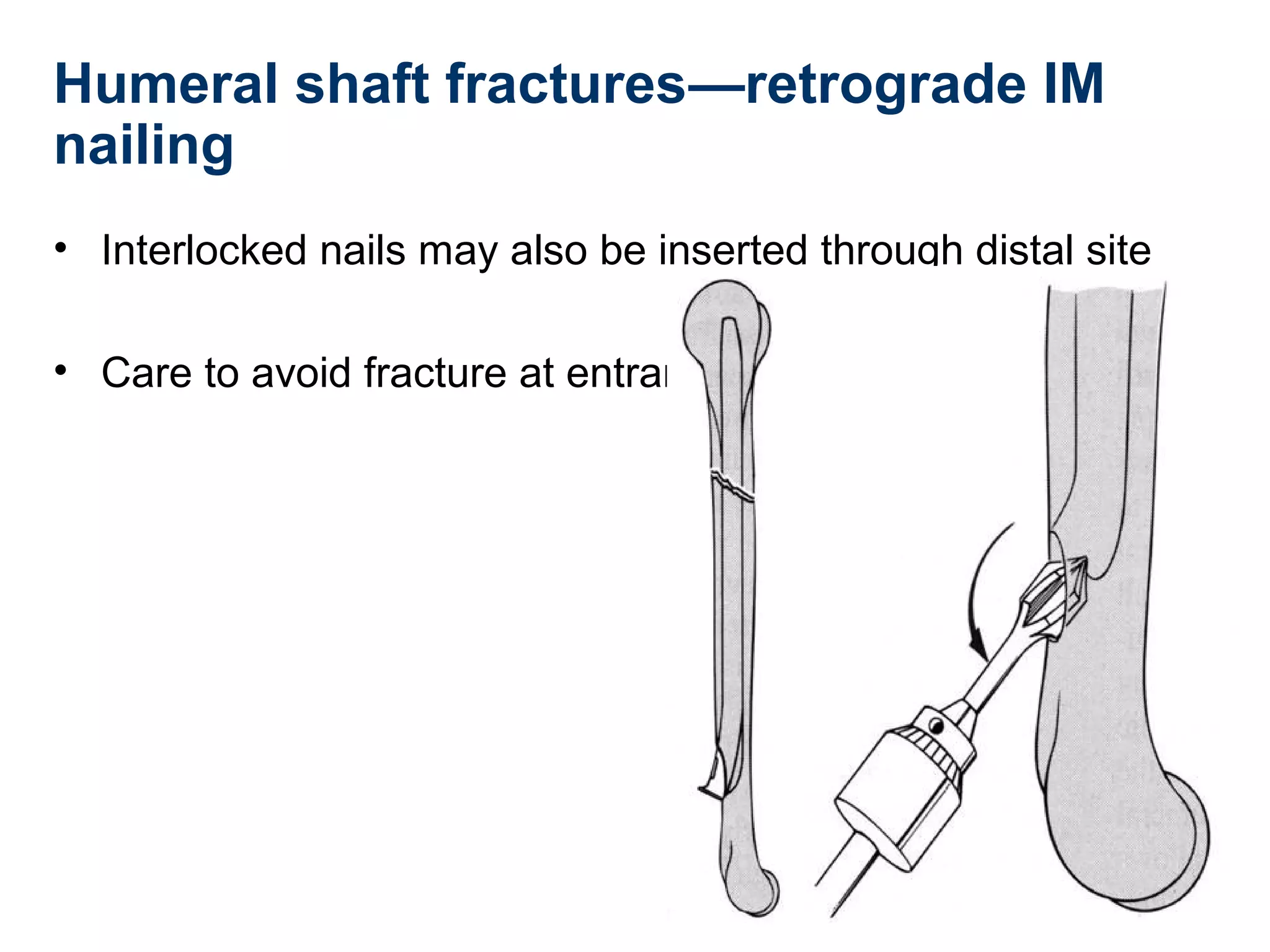Humeral shaft | PPT