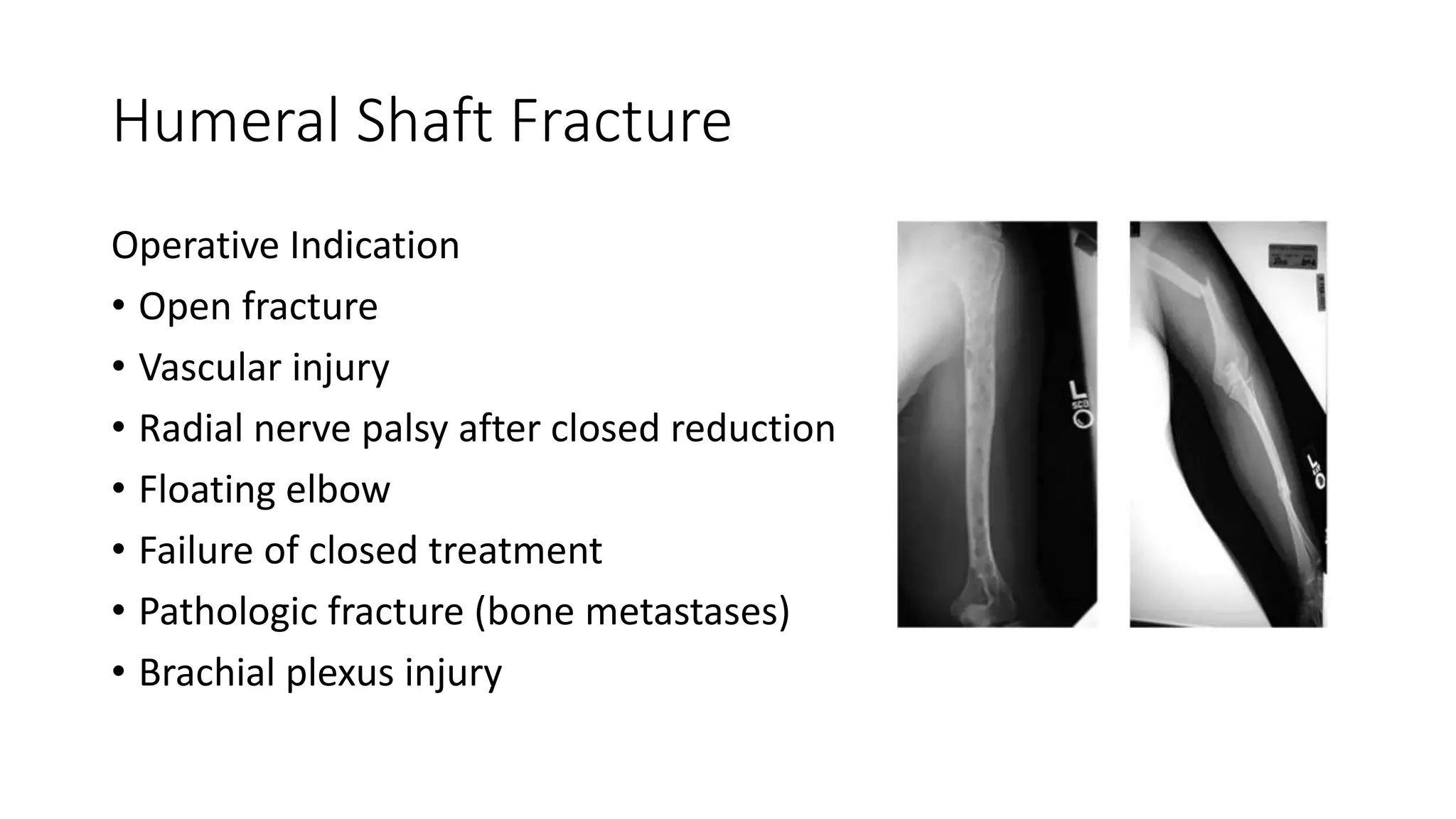 Humeral Shaft Fracture.pptx
