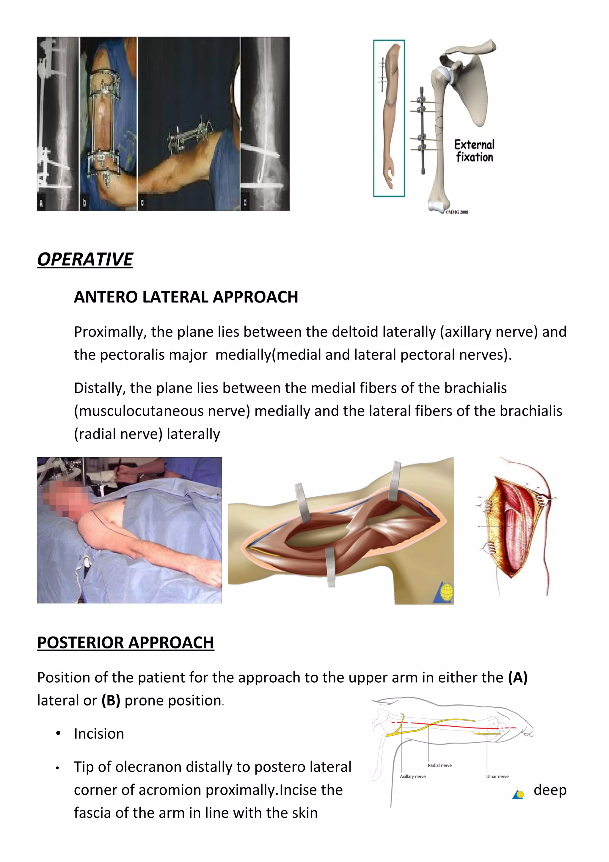 Humeral shaft fractures | ODT