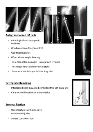 Humeral shaft fractures | ODT