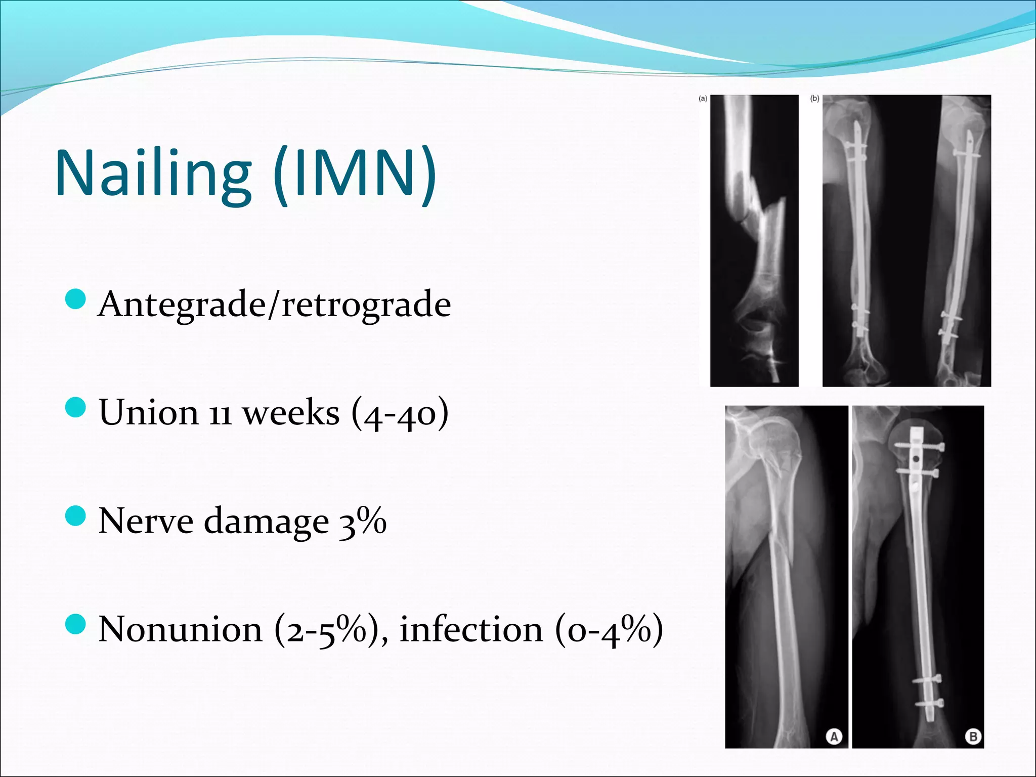 Humerus shaft fractures | PPT