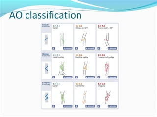 Humerus shaft fractures | PPT | Death, Injury, or Military Conflict ...