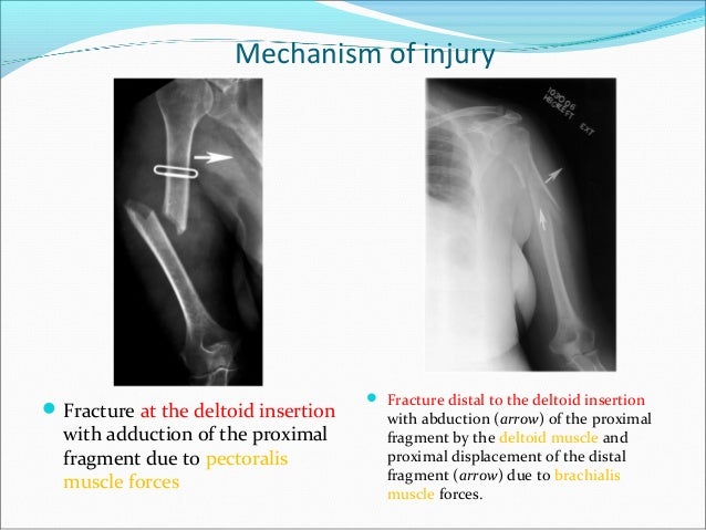 Humerus shaft fractures