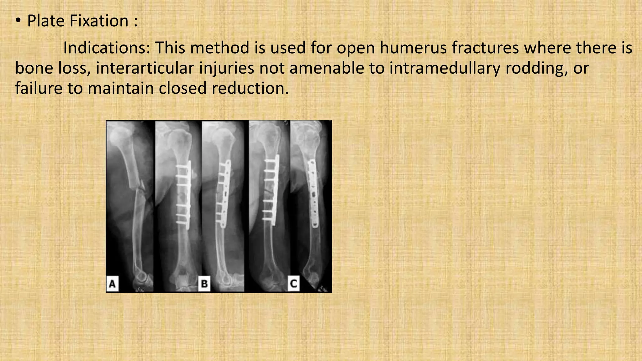Humerus fracture | PPTX