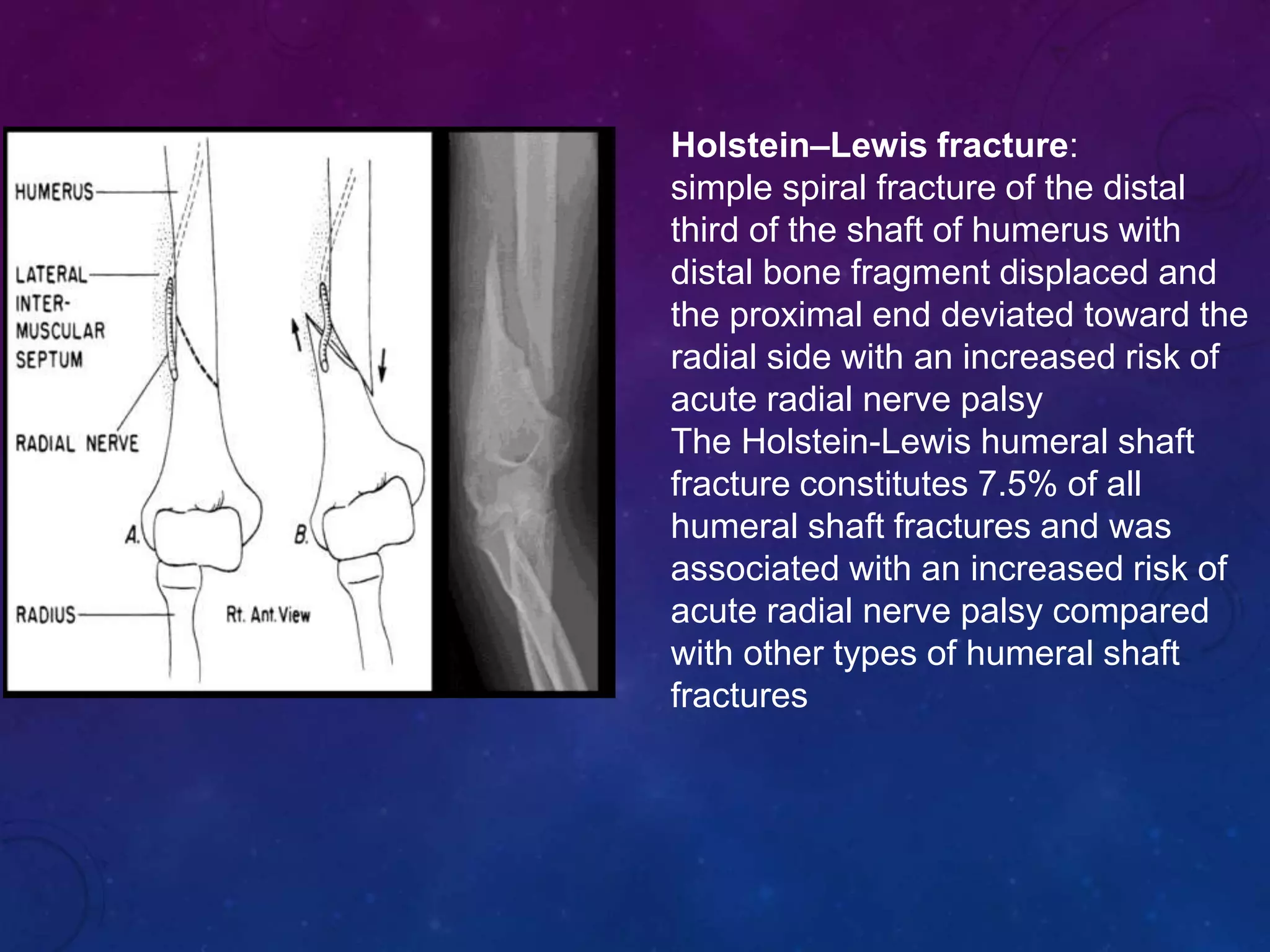 Humerus shaft fracture dr anand | PPTX