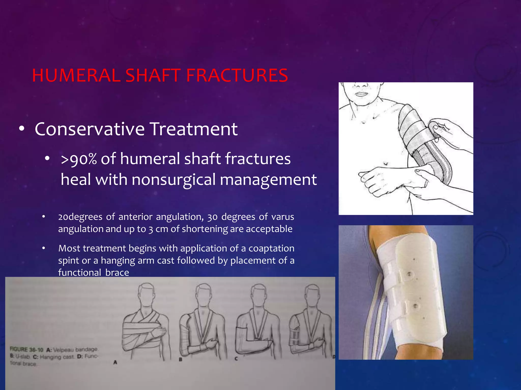 Humerus shaft fracture dr anand | PPTX